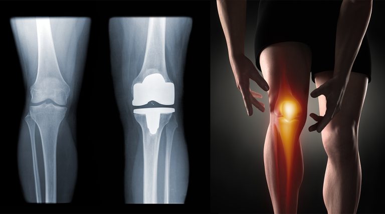 ¿En qué consiste la prótesis de rodilla? | Dra. Linette Gómez